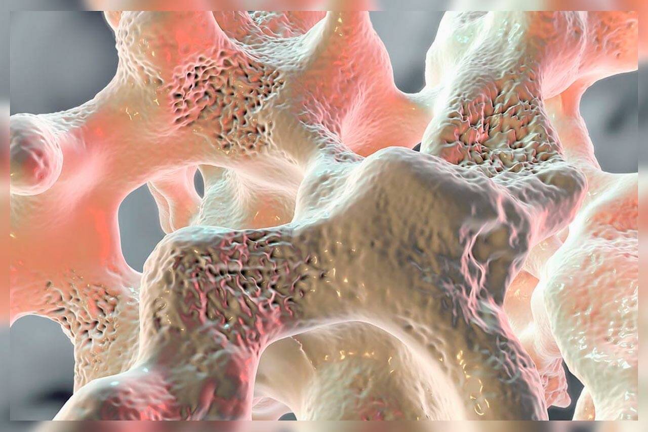 Bone Density Solution Review - Blue Heron Health (Shelly Manning ...